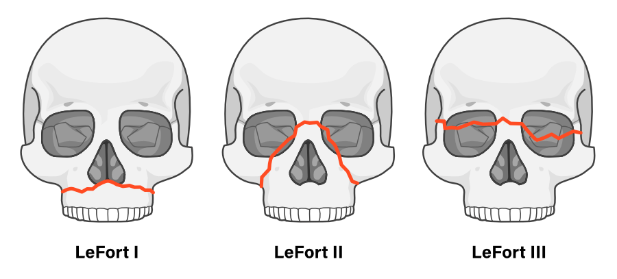 Le Fort Midface Fracture Classification